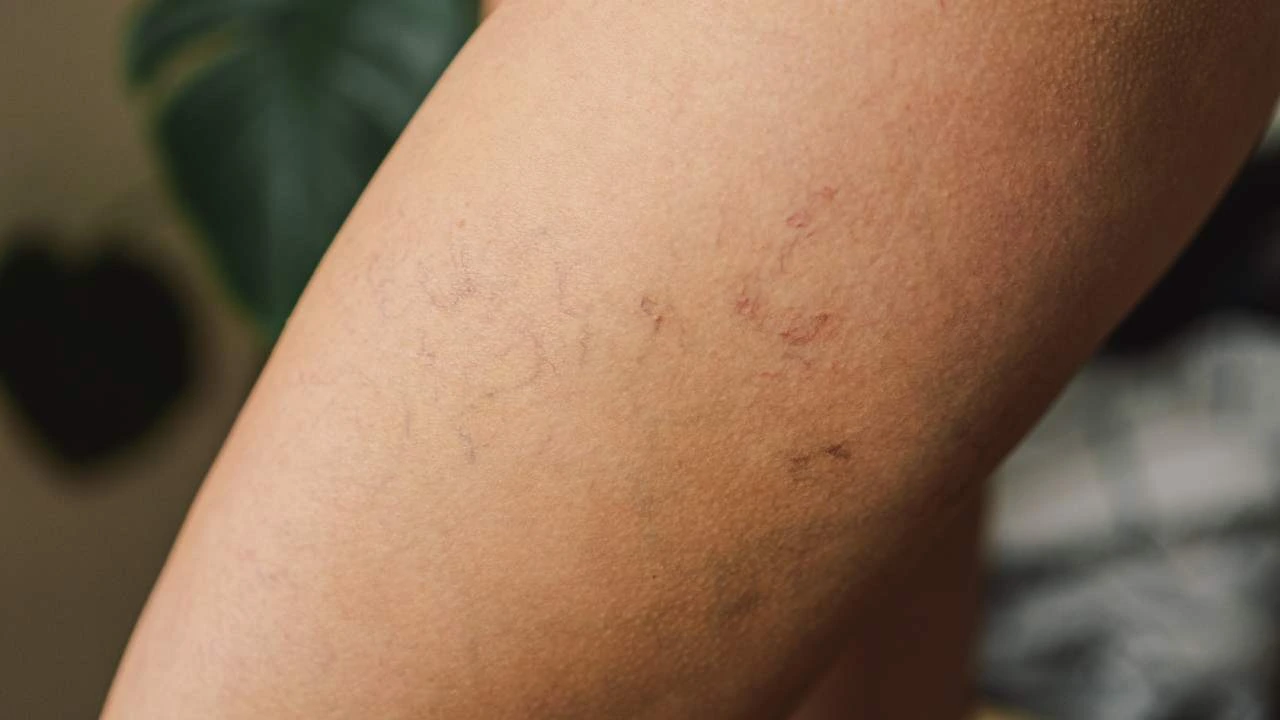 Find the Best Treatment for Spider Veins in Farmington, CT